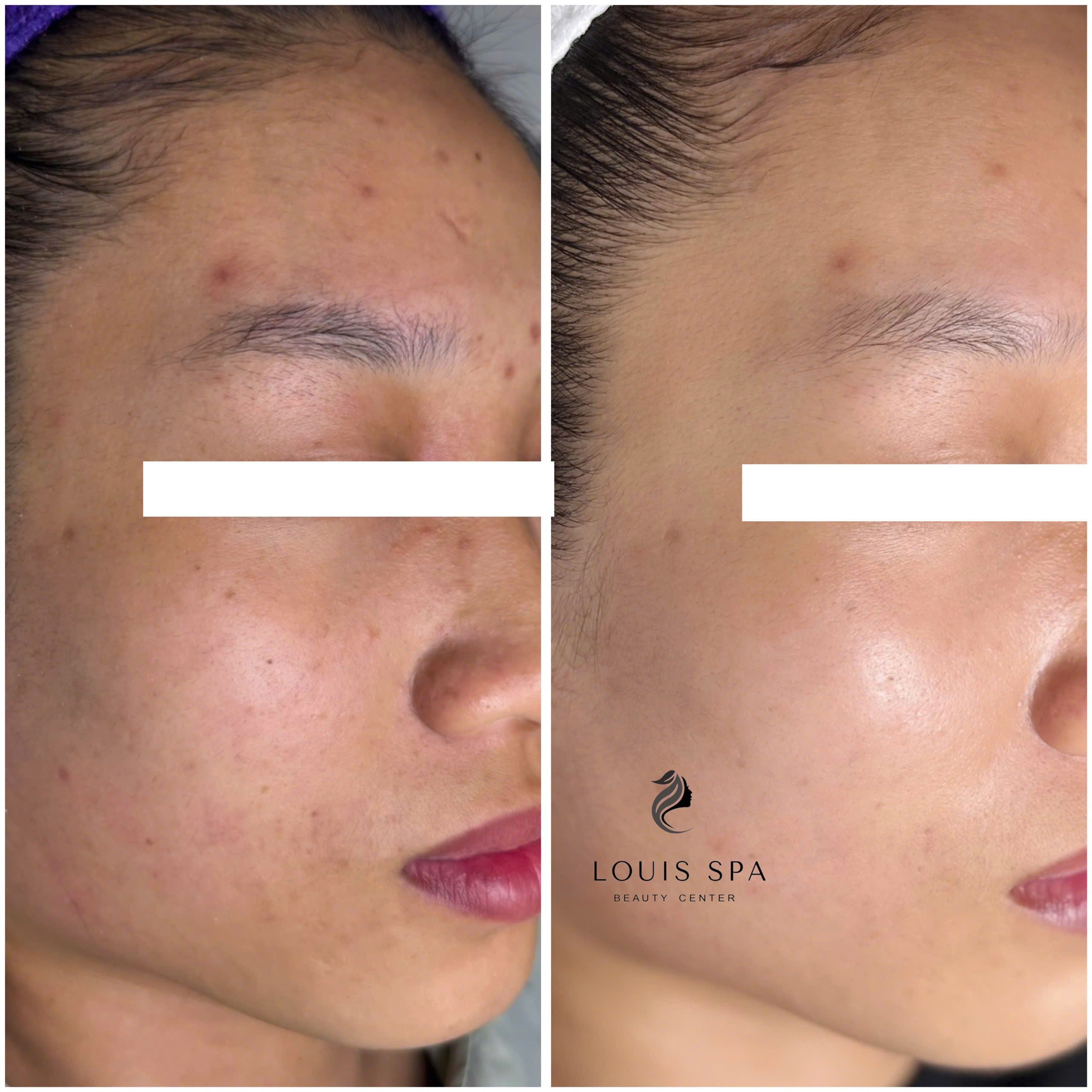 Peel da và những điều cần biết - Spa Phan Thiết - Louis spa phan thiết